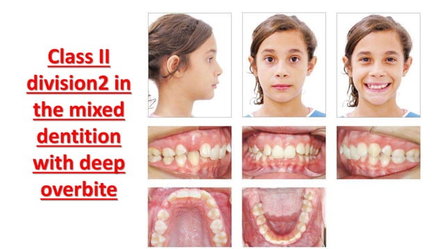 Orthodontic treatment of deep bite part 1 | PPTX | Oral care | Personal ...