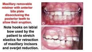 Orthodontic treatment of deep bite part 1 | PPTX