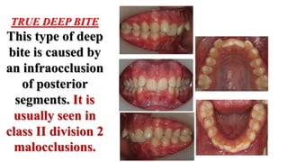 Orthodontic treatment of deep bite part 1 | PPT