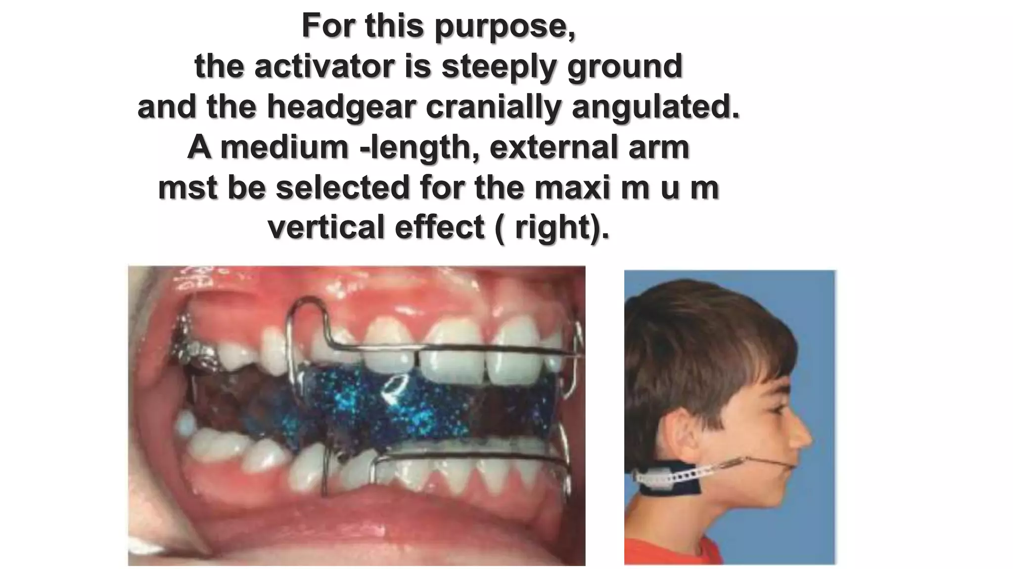Orthodontic treatment of deep bite part 2 | PPTX