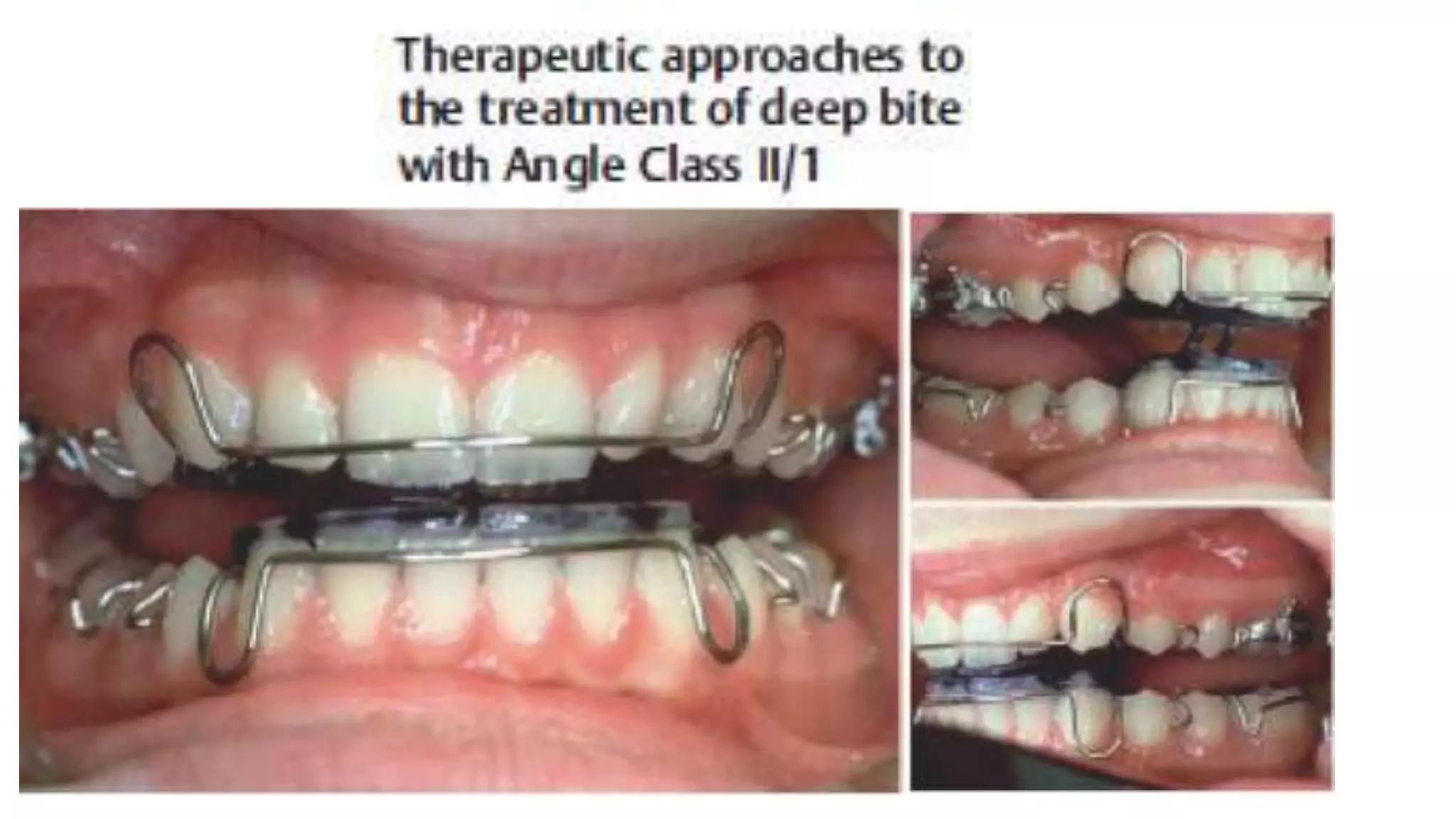 Orthodontic treatment of deep bite part 2 | PPTX