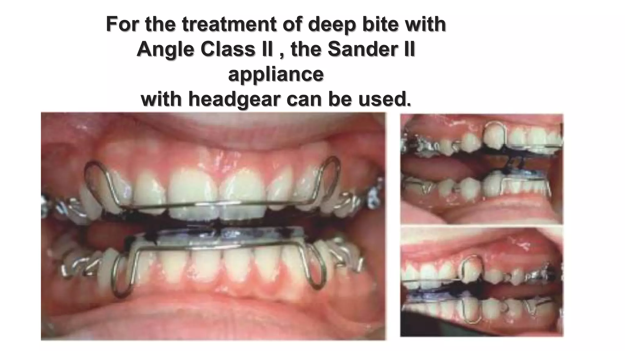 Orthodontic treatment of deep bite part 2 | PPTX
