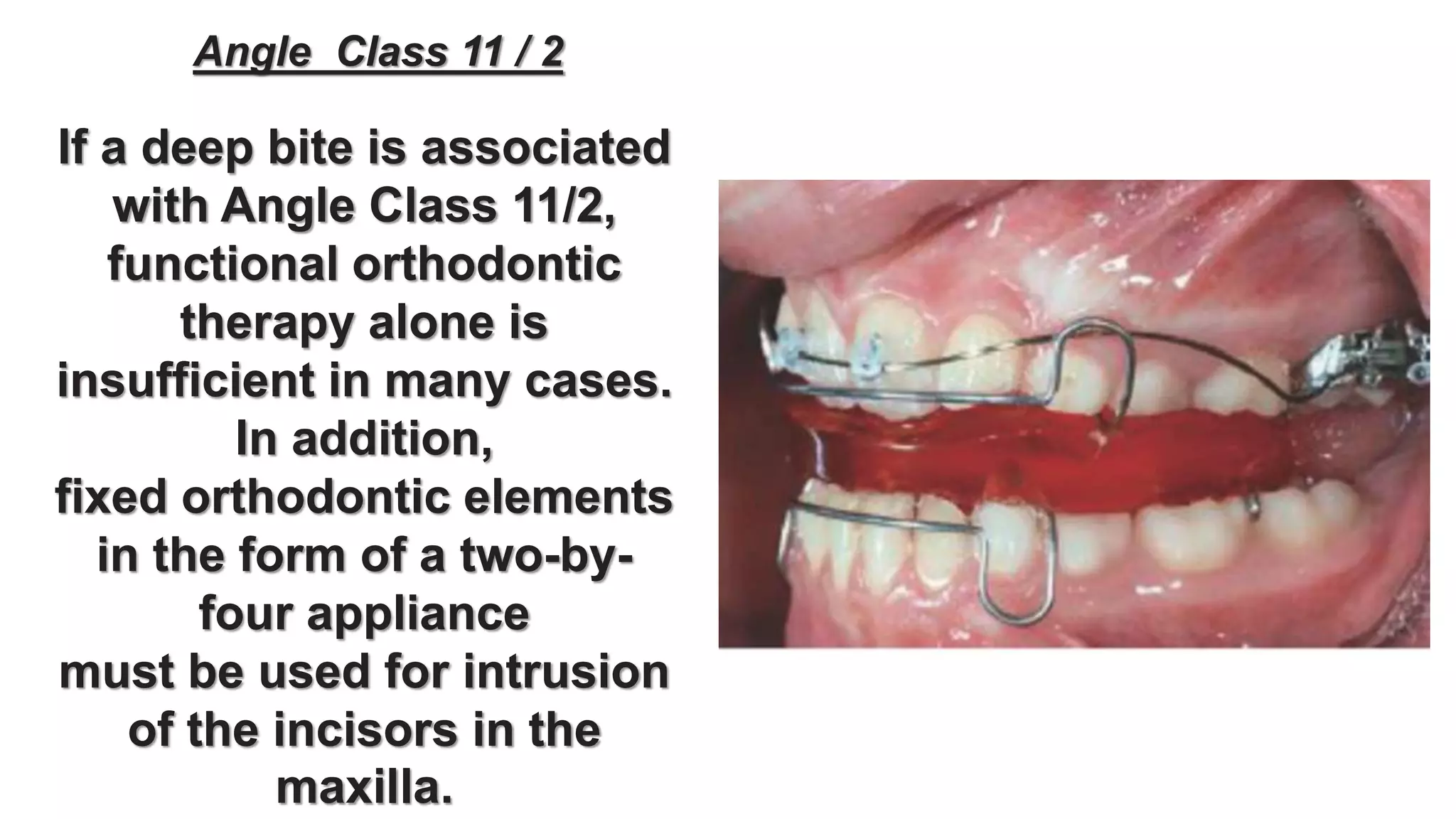 Orthodontic treatment of deep bite part 2 | PPTX