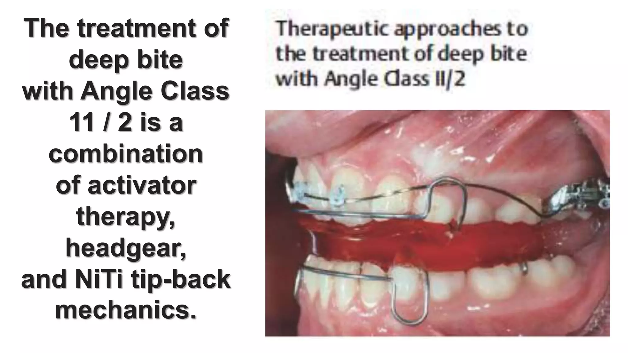 Orthodontic treatment of deep bite part 2 | PPTX