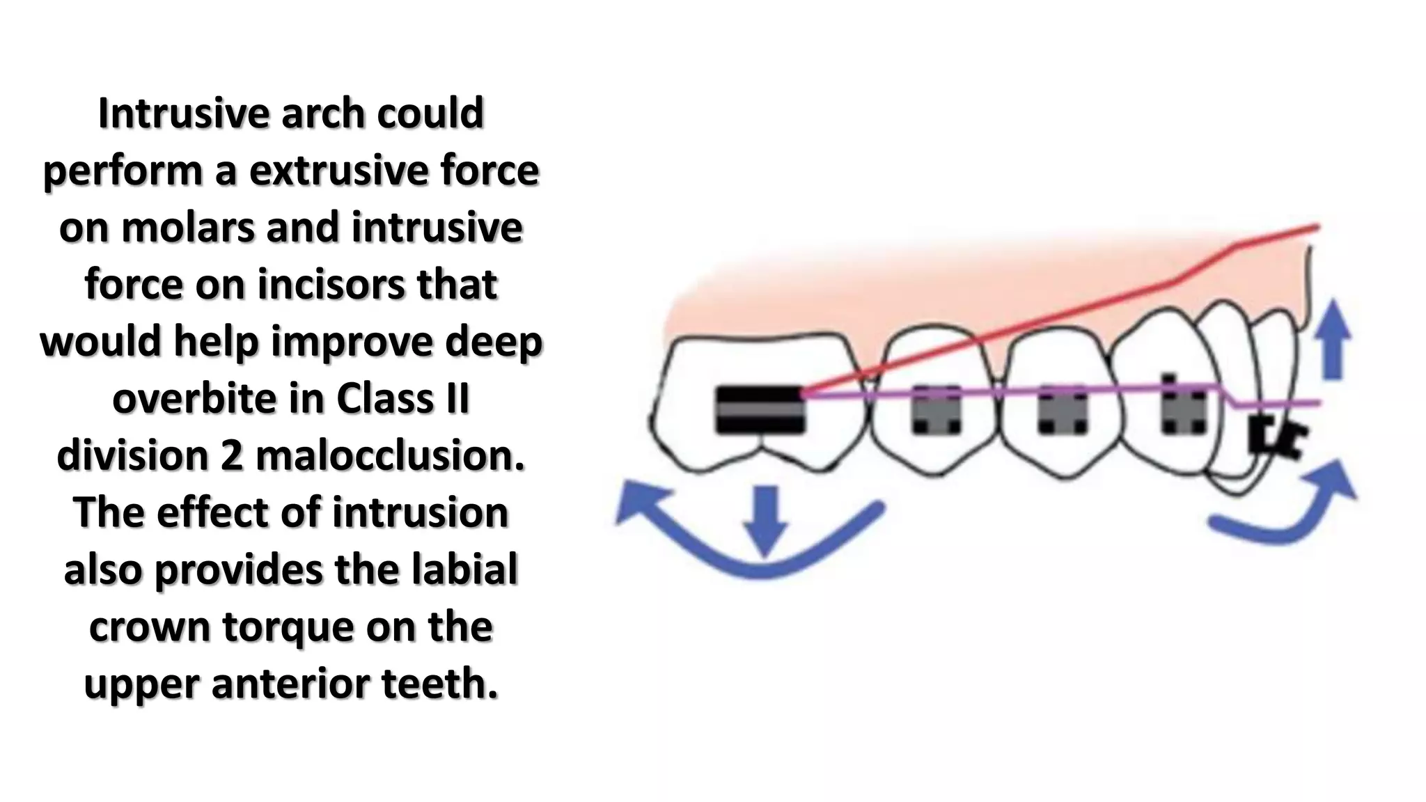 Orthodontic treatment of deep bite part 2 | PPTX
