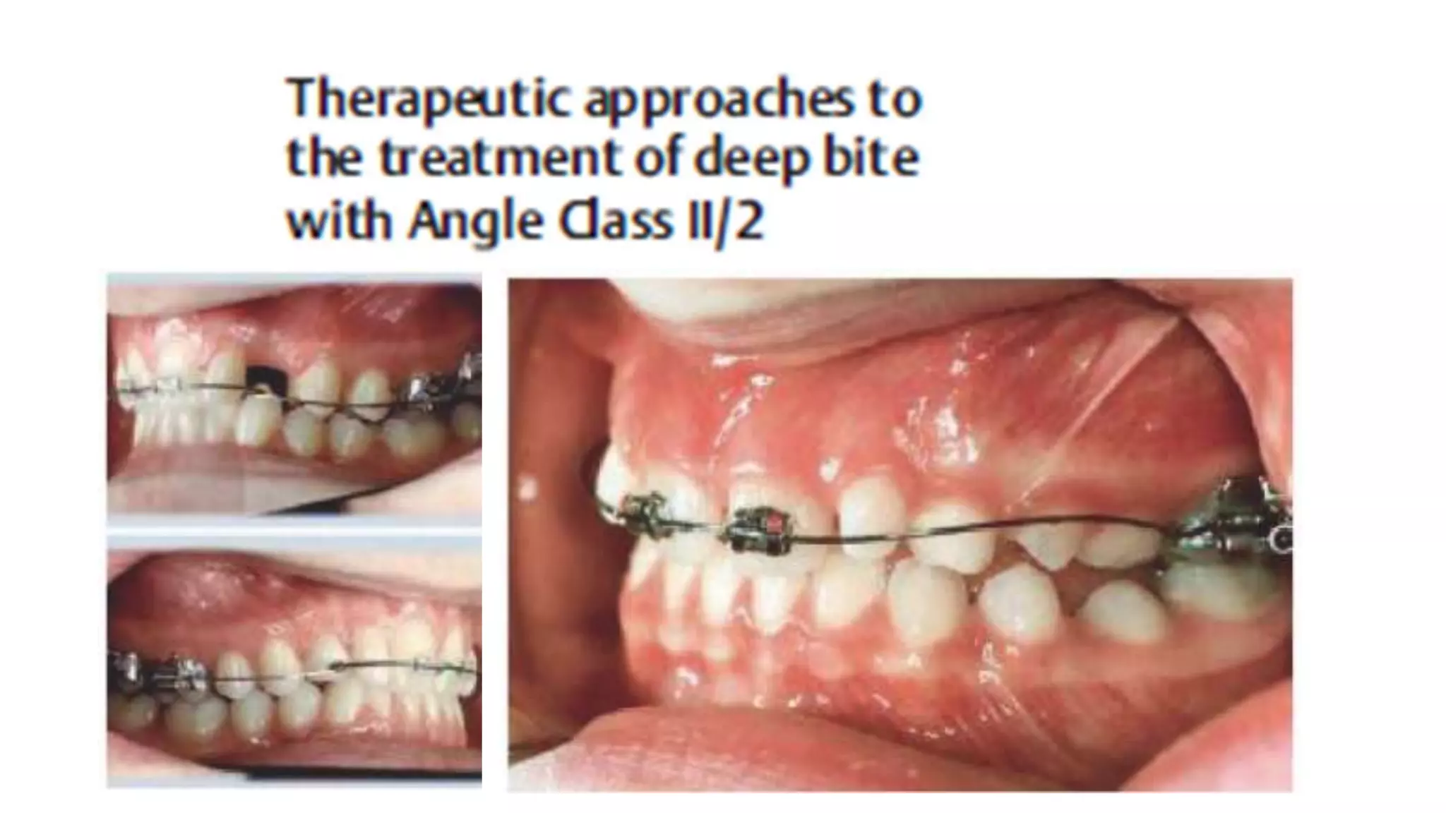 Orthodontic treatment of deep bite part 2 | PPTX