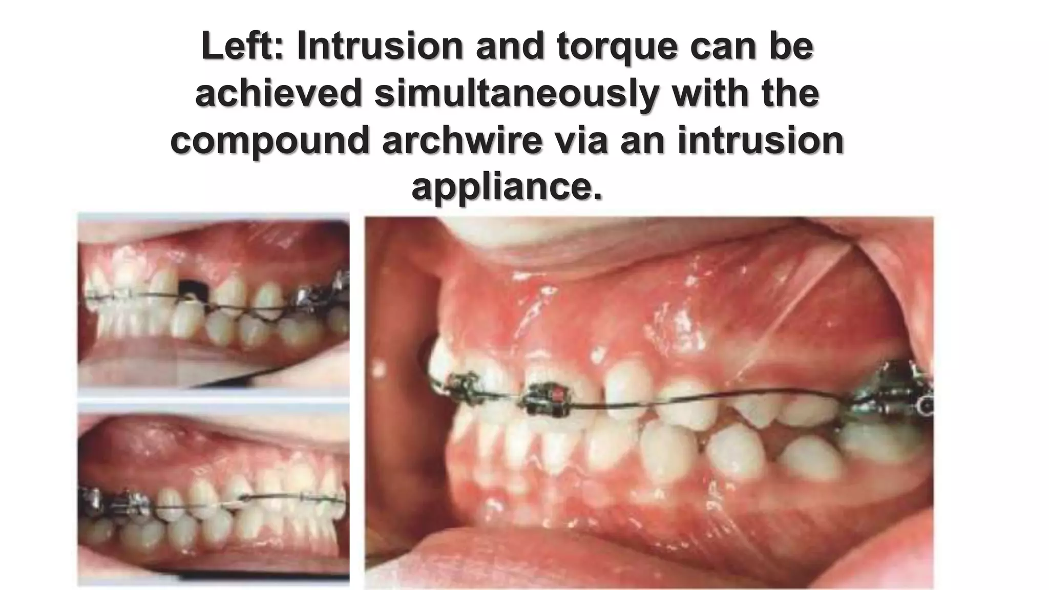 Orthodontic treatment of deep bite part 2 | PPTX