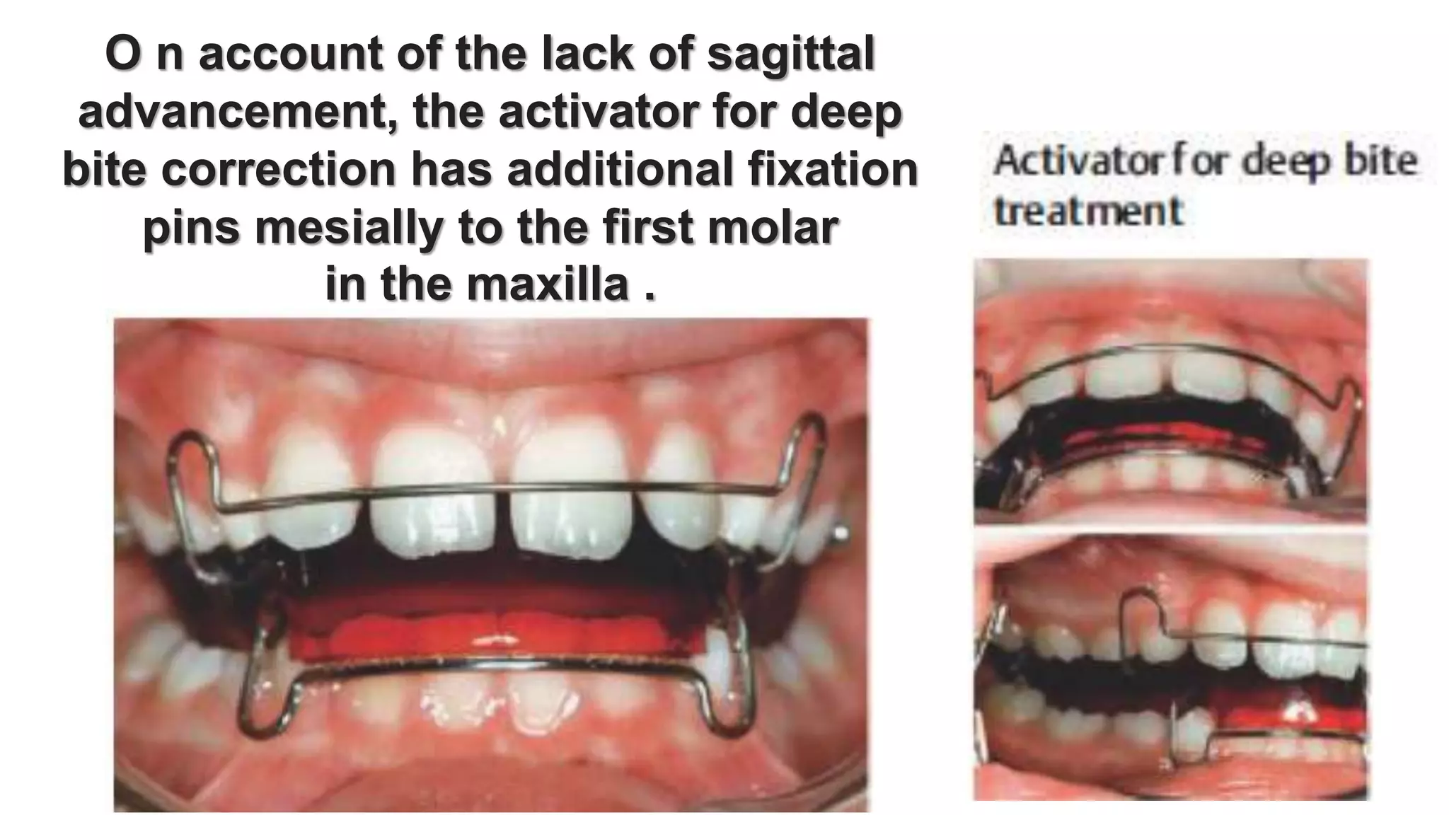 Orthodontic treatment of deep bite part 2 | PPTX