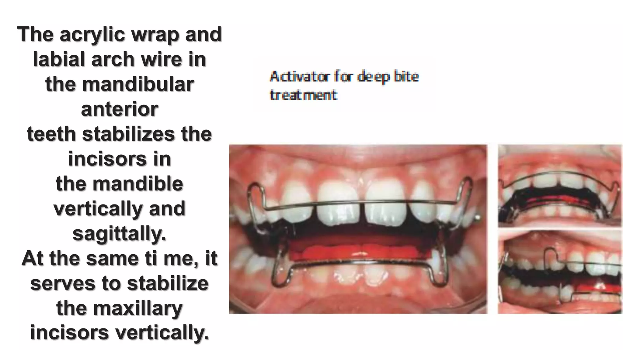 Orthodontic treatment of deep bite part 2 | PPTX