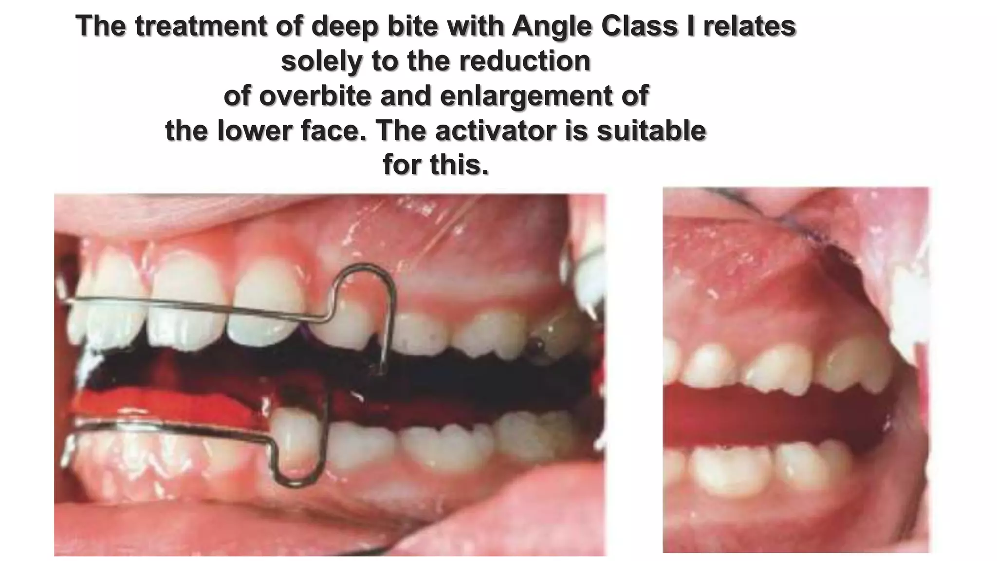 Orthodontic treatment of deep bite part 2 | PPTX