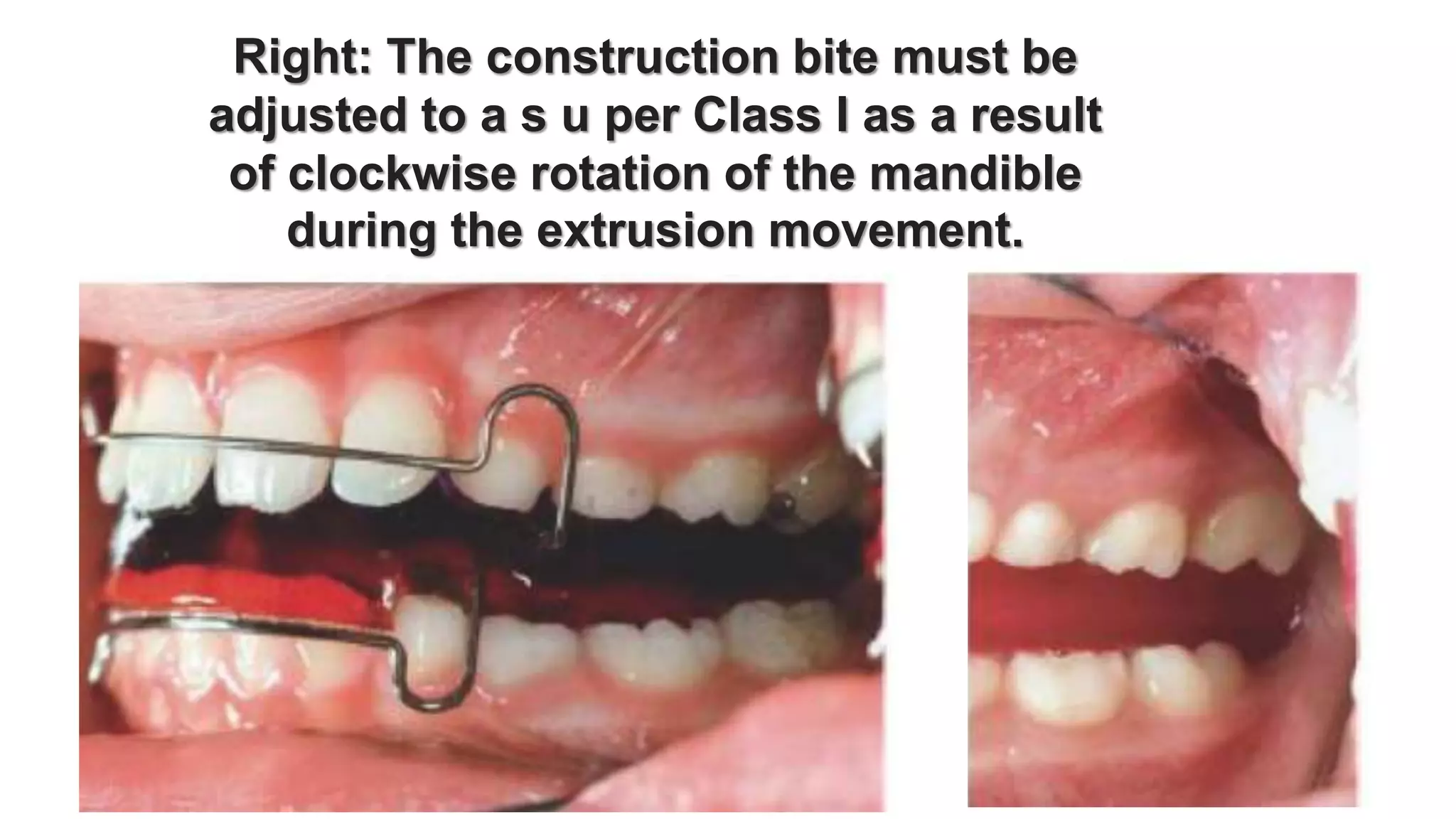 Orthodontic treatment of deep bite part 2 | PPTX