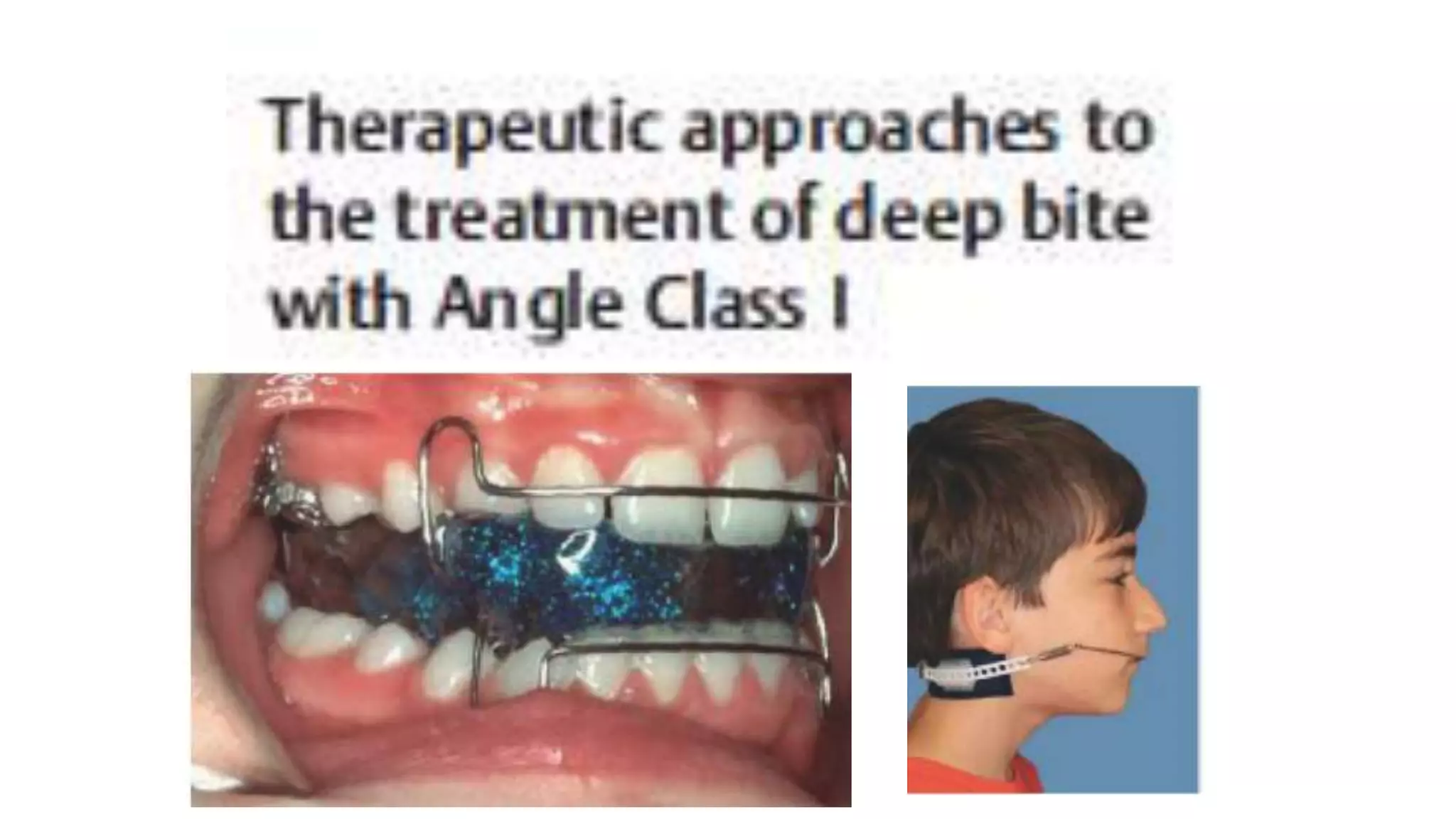 Orthodontic treatment of deep bite part 2 | PPTX