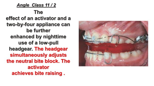 Orthodontic treatment of deep bite part 2 | PPTX | Dental Health ...