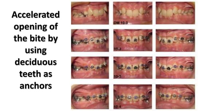 Orthodontic treatment of deep bite part 2 | PPTX | Dental Health ...
