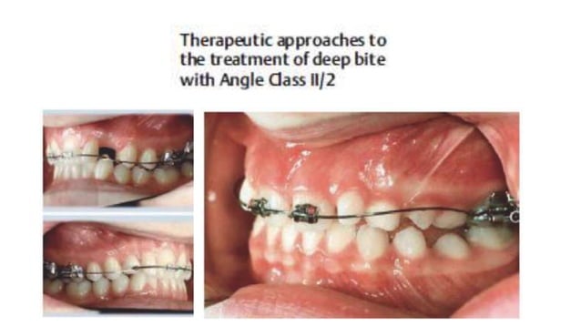 Orthodontic treatment of deep bite part 2 | PPTX | Dental Health ...