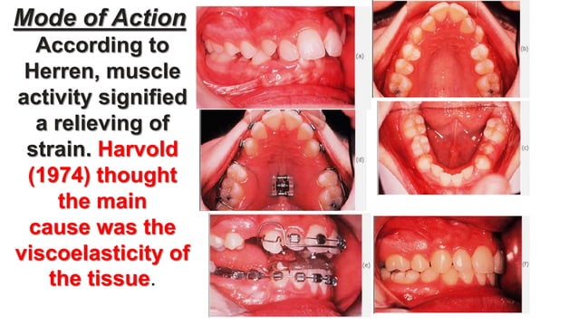 Orthodontic treatment of deep bite part 2 | PPTX | Dental Health ...