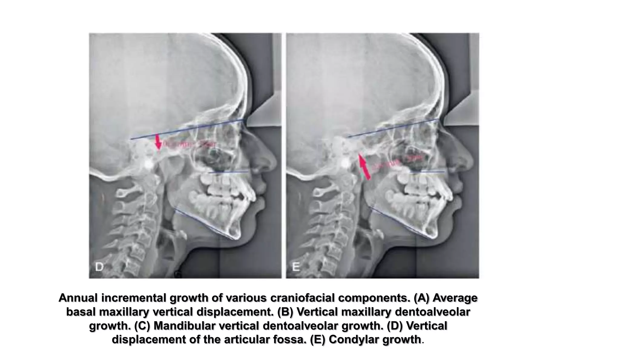 Orthodontic vertical discrepancies 1- LONG FACE | PPTX