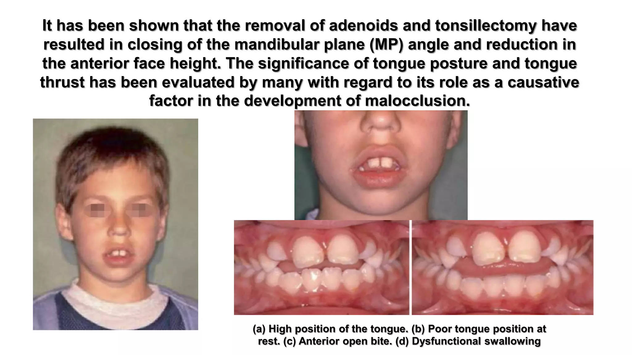 Orthodontic vertical discrepancies 1- LONG FACE | PPTX