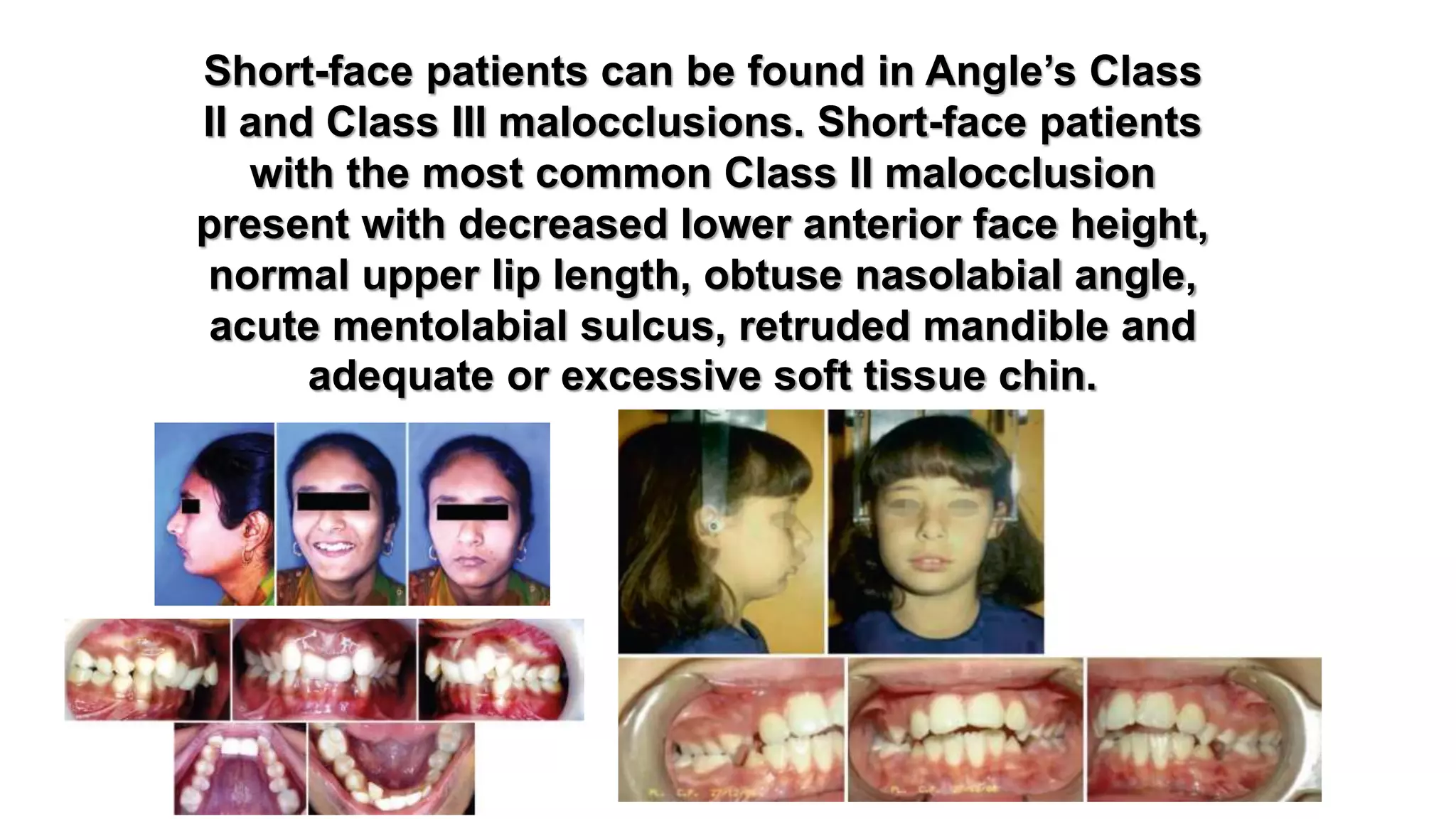 Orthodontic vertical discrepancies 1- LONG FACE | PPTX