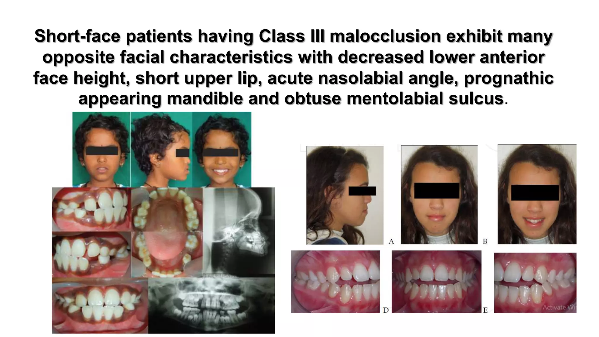 Orthodontic vertical discrepancies 1- LONG FACE | PPTX