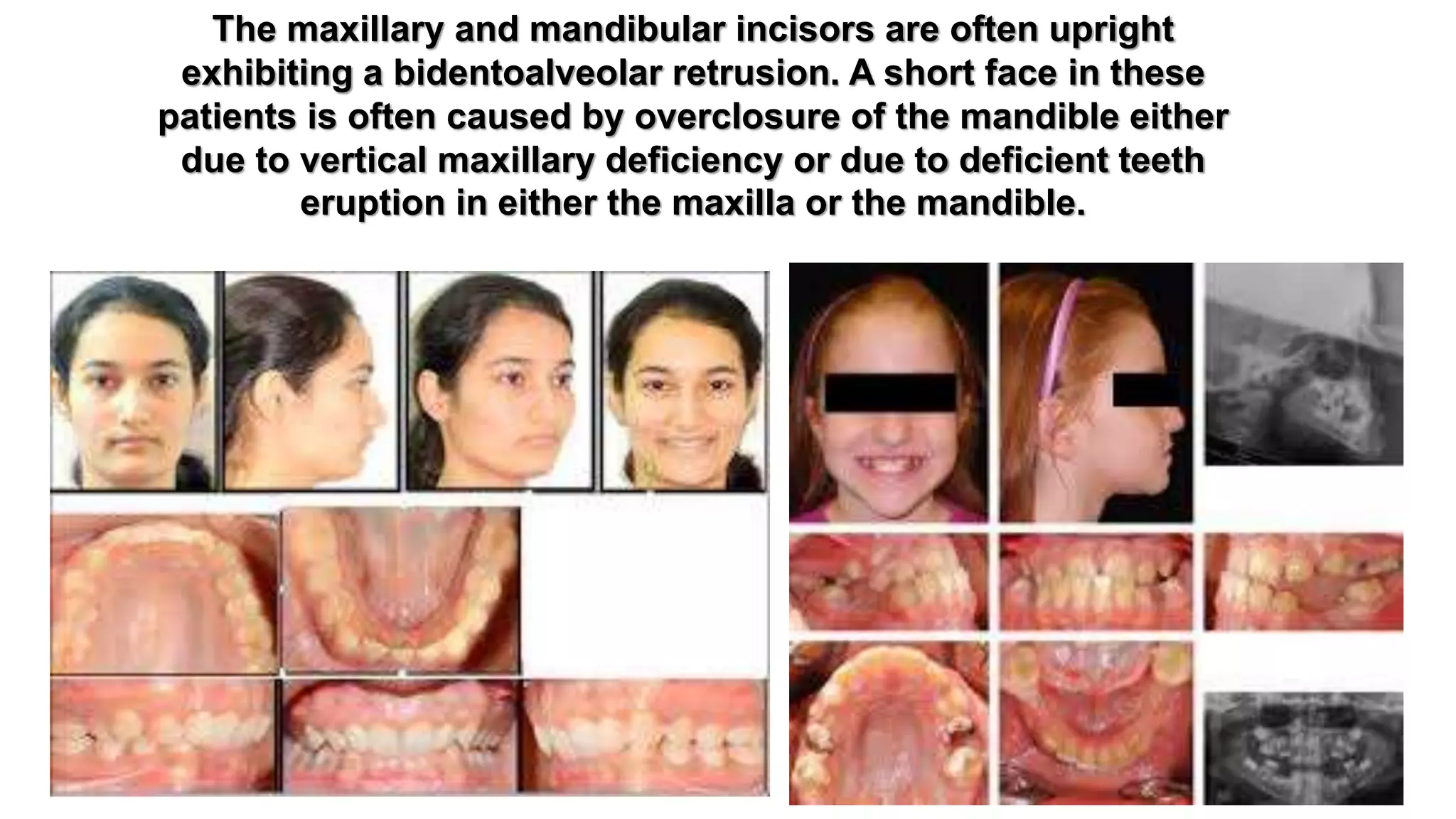 Orthodontic vertical discrepancies 1- LONG FACE | PPTX