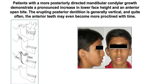 Orthodontic vertical discrepancies 1- LONG FACE | PPTX