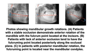 Orthodontic vertical discrepancies 1- LONG FACE | PPTX