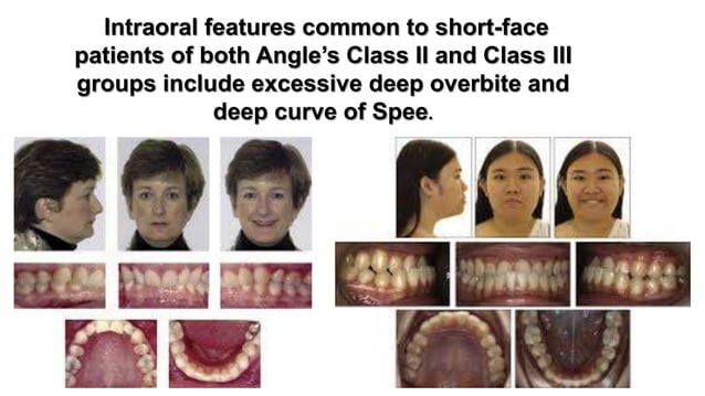 Orthodontic vertical discrepancies 1- LONG FACE | PPTX