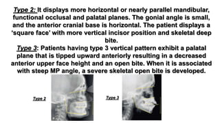 Orthodontic vertical discrepancies 1- LONG FACE | PPTX