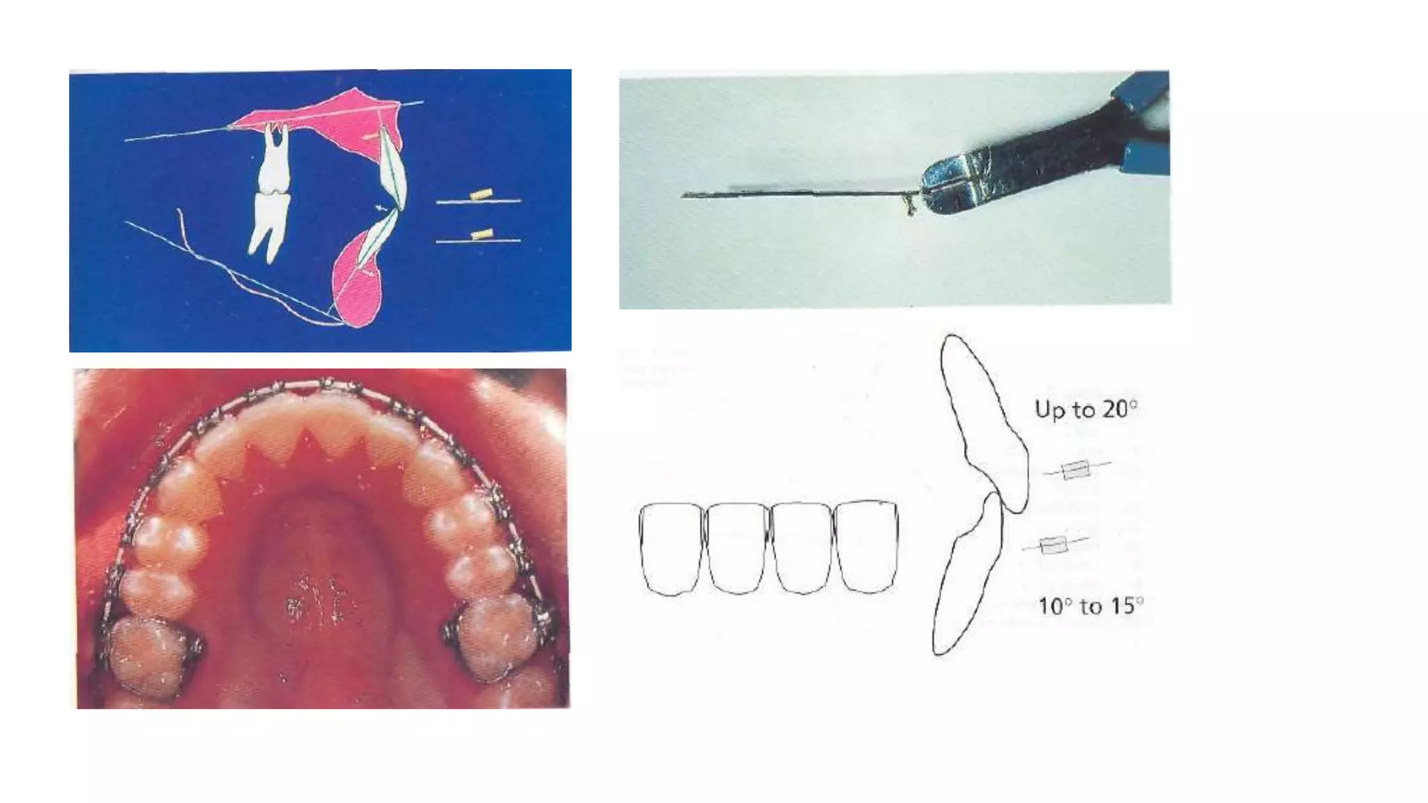 MBT wire sequence during orthodontic alignment and leveling | PPTX