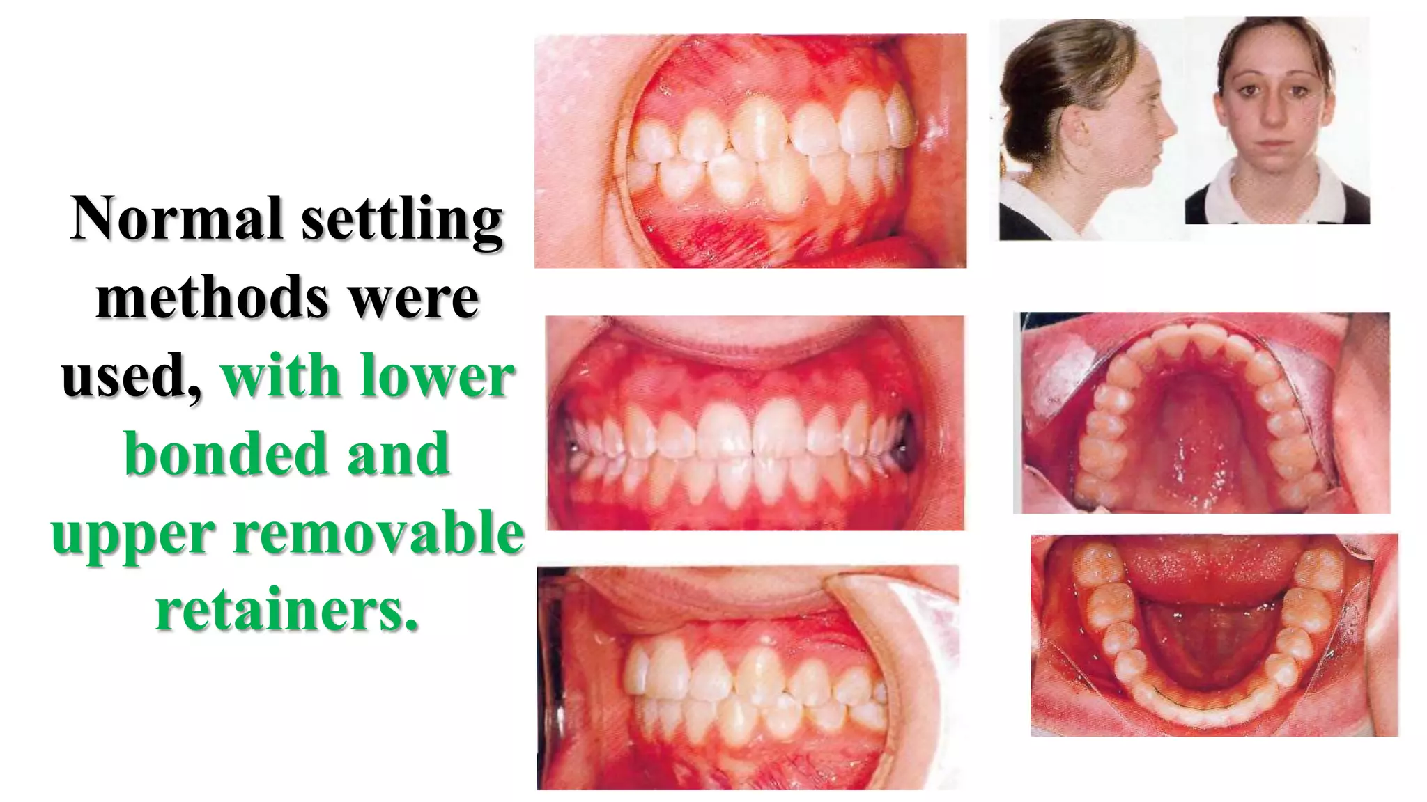 MBT wire sequence during orthodontic alignment and leveling | PPTX