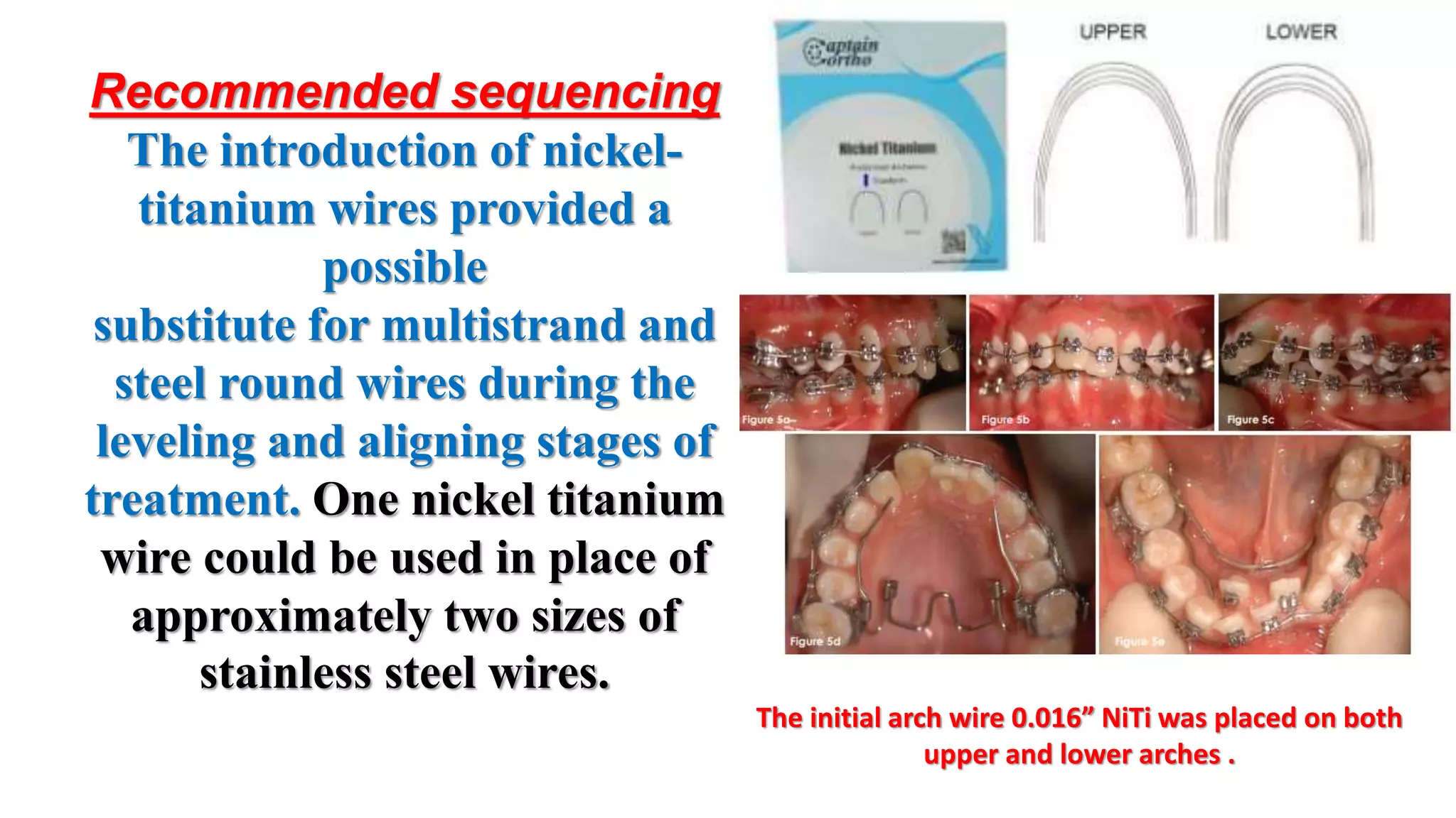 MBT wire sequence during orthodontic alignment and leveling | PPTX