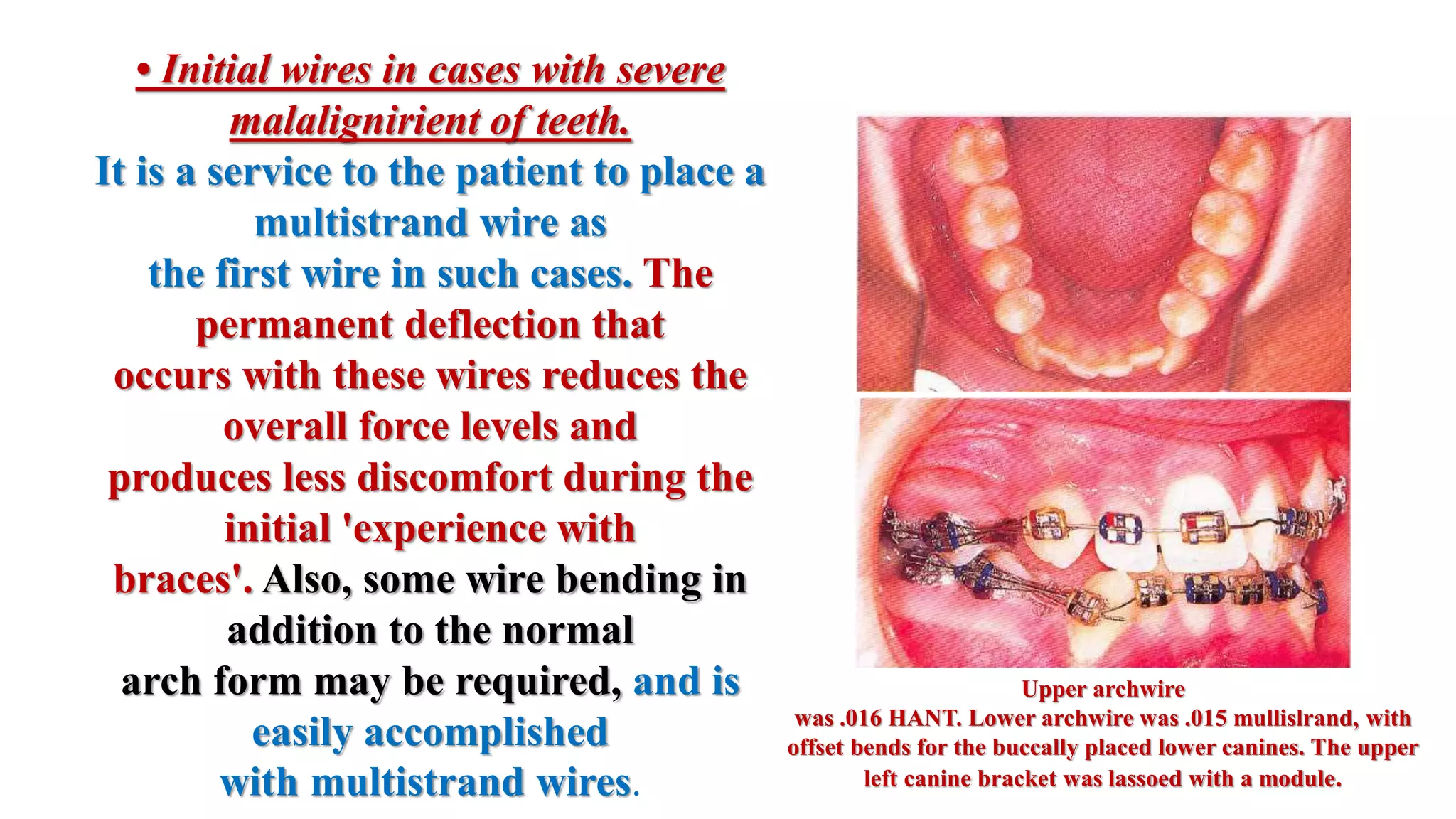 MBT wire sequence during orthodontic alignment and leveling | PPTX