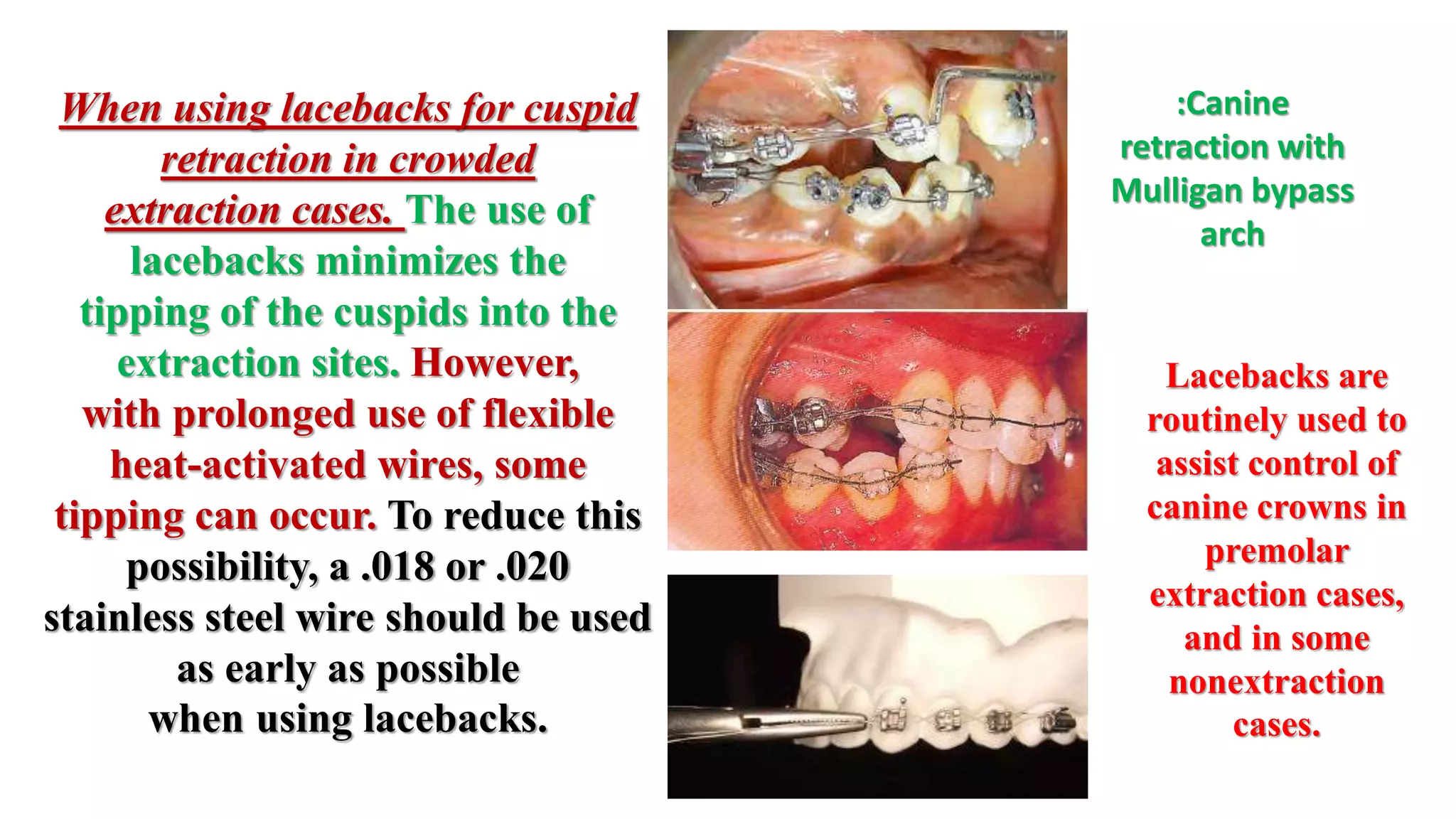 MBT wire sequence during orthodontic alignment and leveling | PPTX