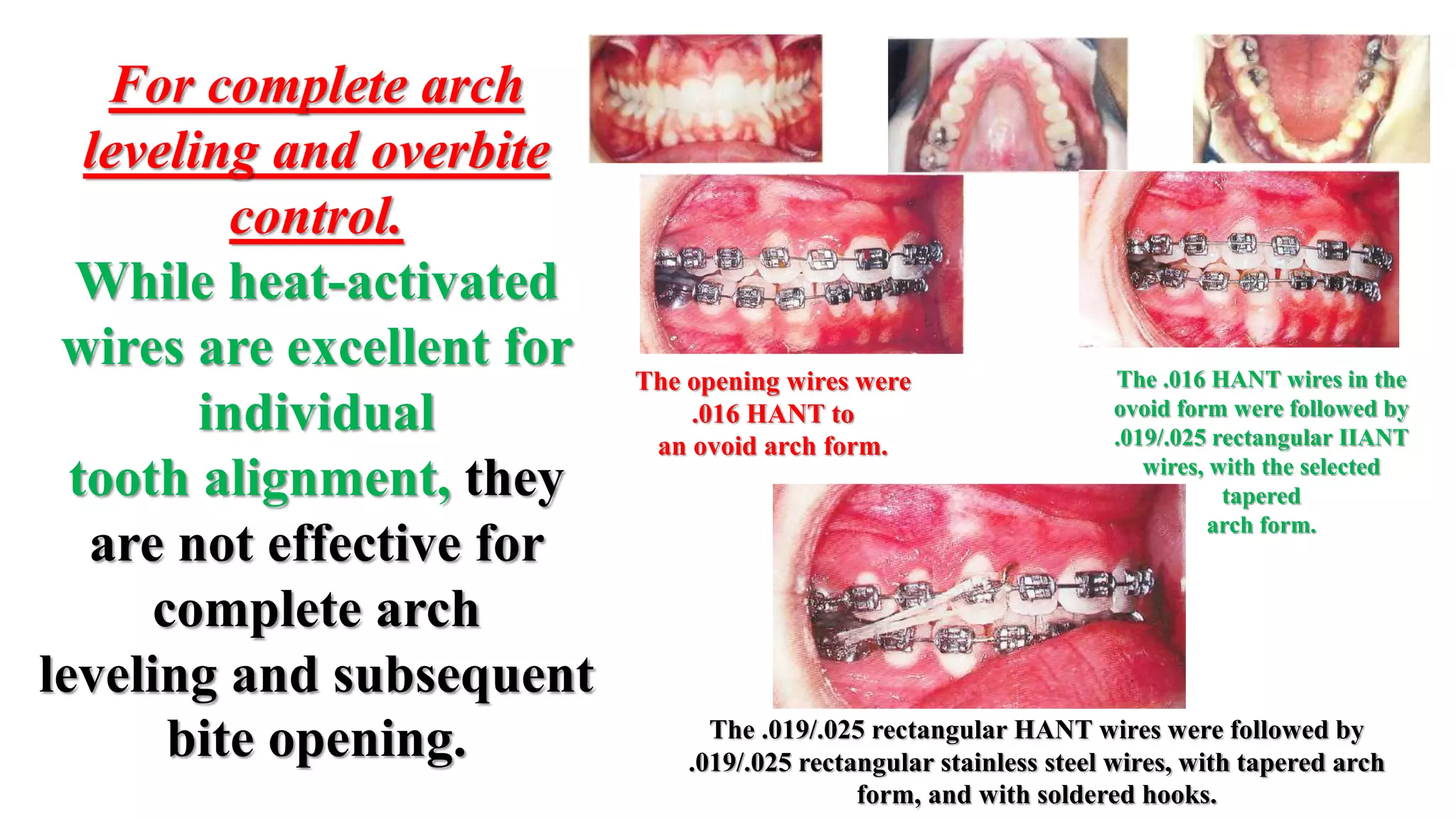MBT wire sequence during orthodontic alignment and leveling | PPTX