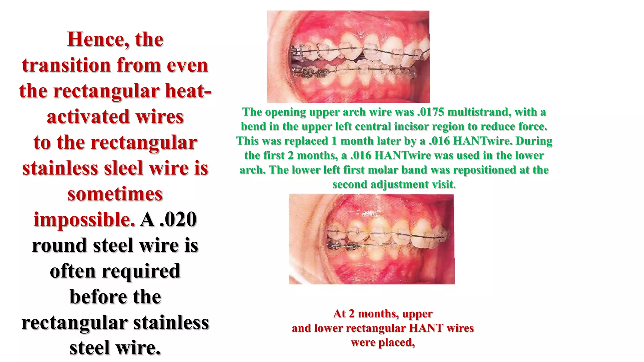 MBT wire sequence during orthodontic alignment and leveling | PPTX