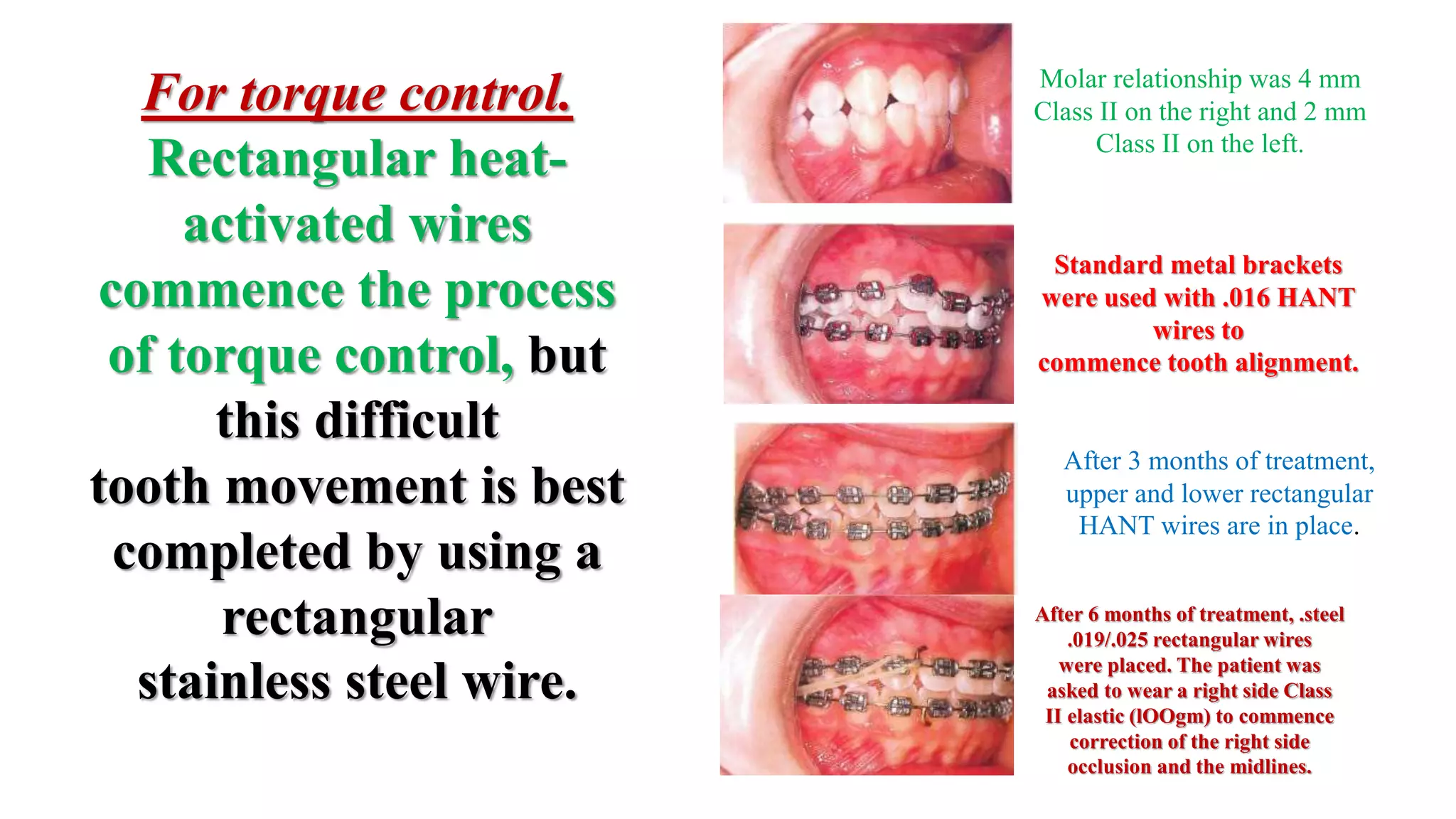 MBT wire sequence during orthodontic alignment and leveling | PPTX