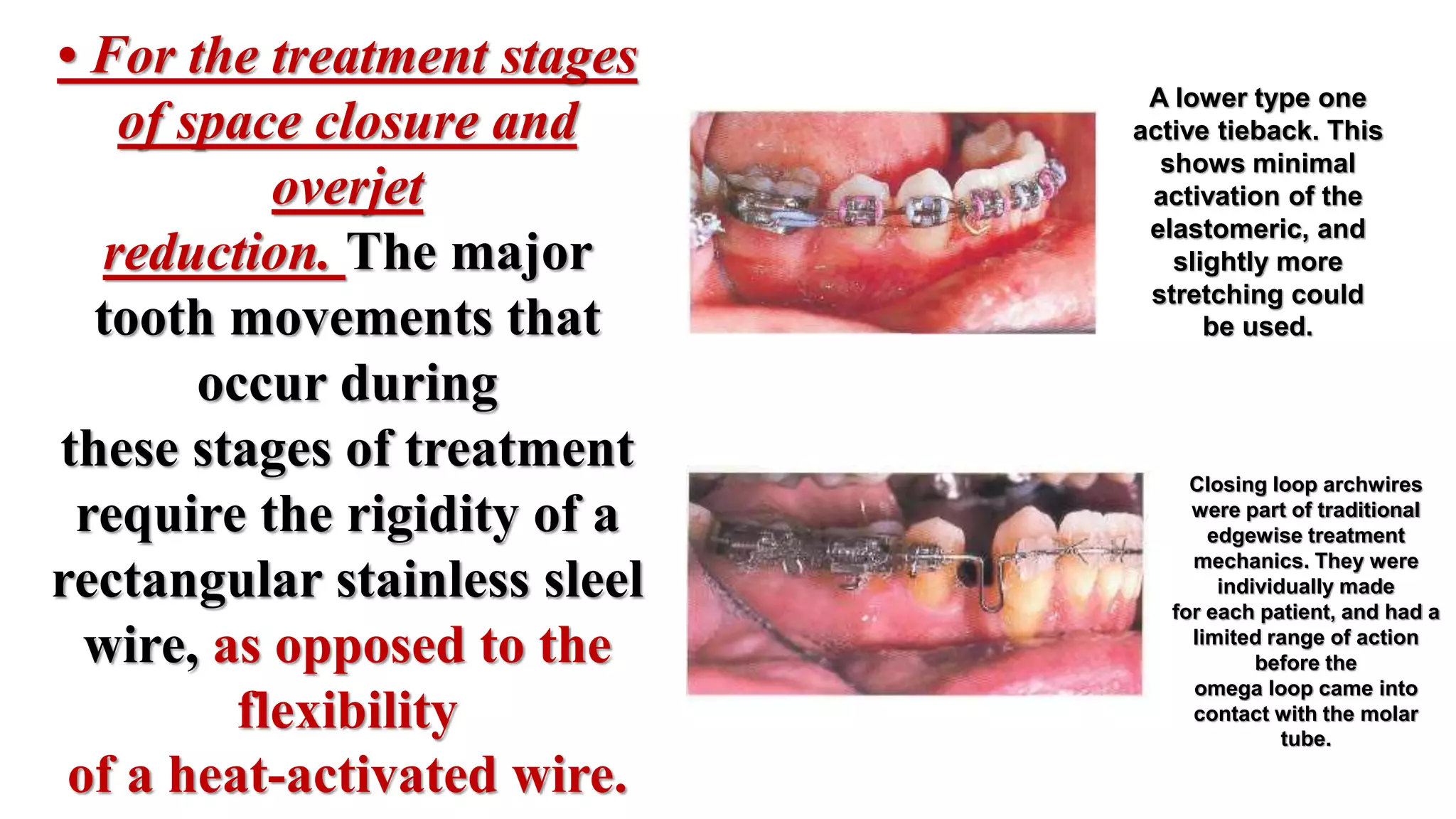 MBT wire sequence during orthodontic alignment and leveling | PPTX