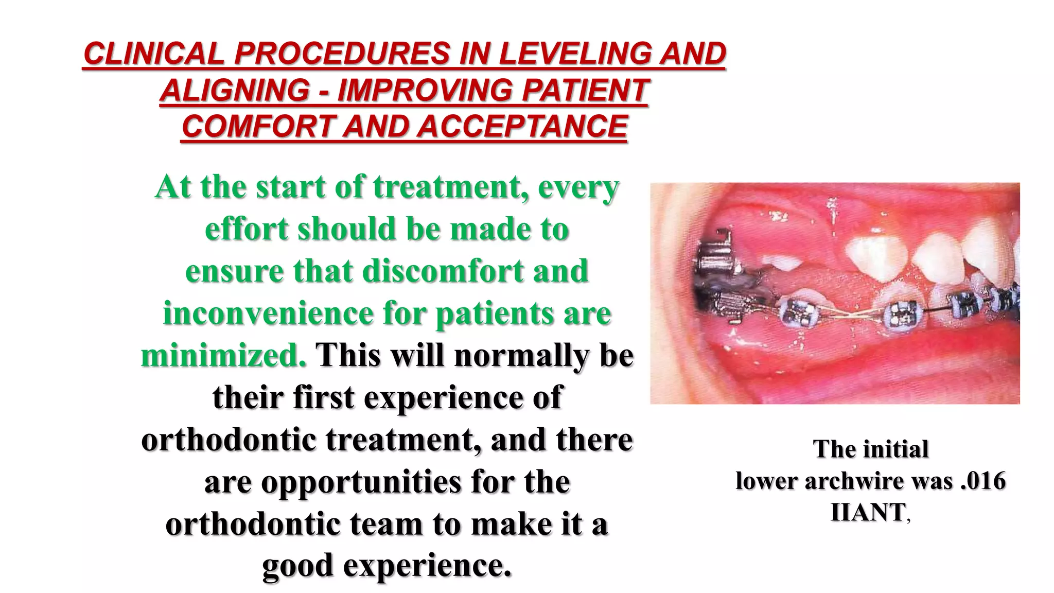 MBT wire sequence during orthodontic alignment and leveling | PPTX