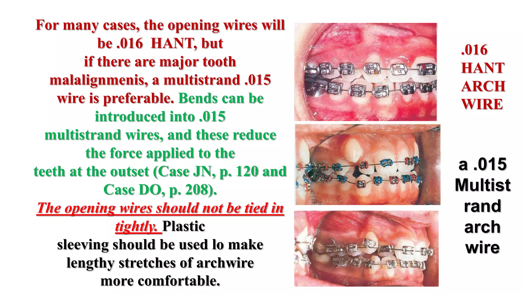 MBT wire sequence during orthodontic alignment and leveling | PPTX