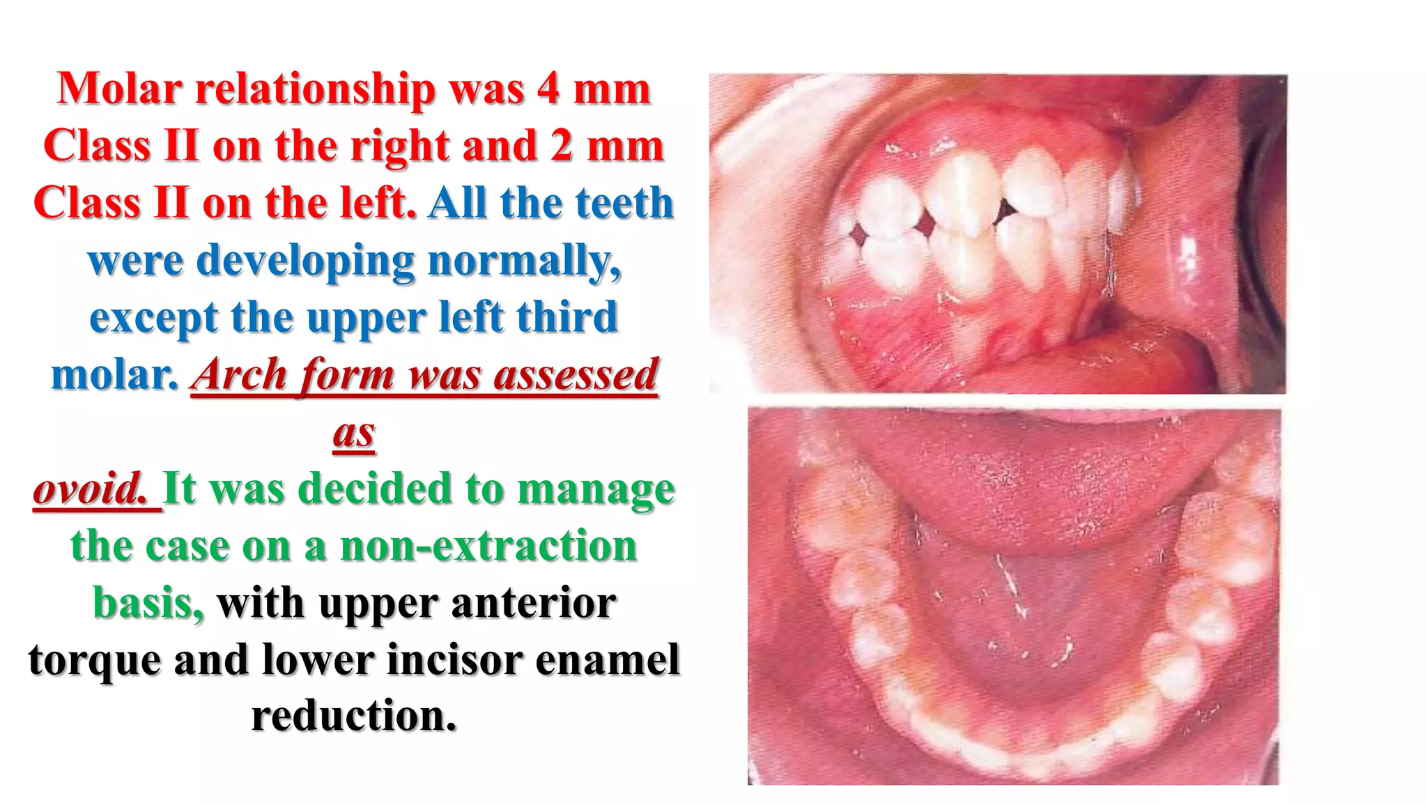 MBT wire sequence during orthodontic alignment and leveling | PPTX