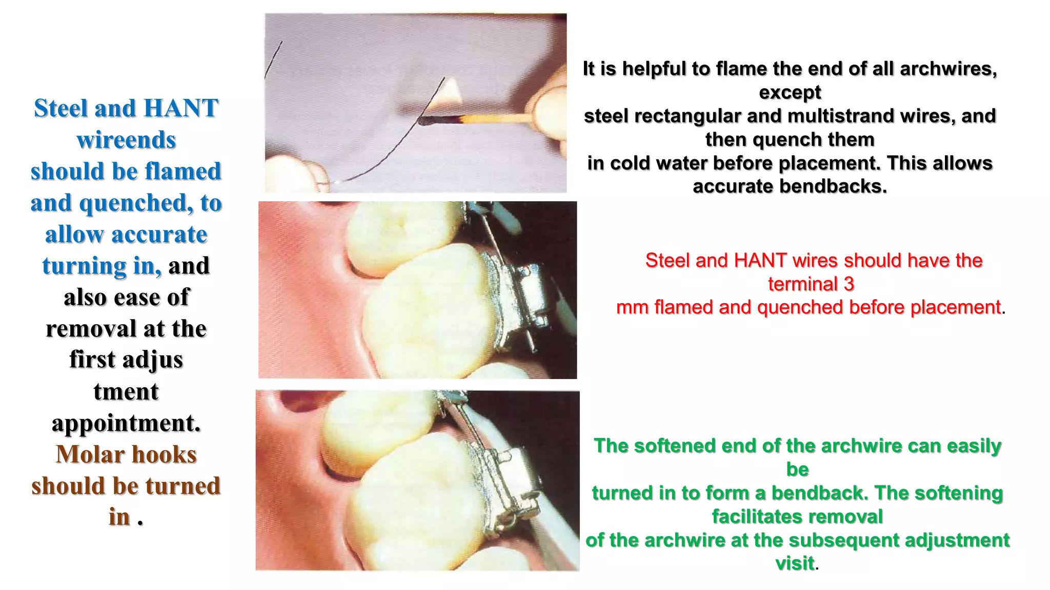 MBT wire sequence during orthodontic alignment and leveling | PPTX