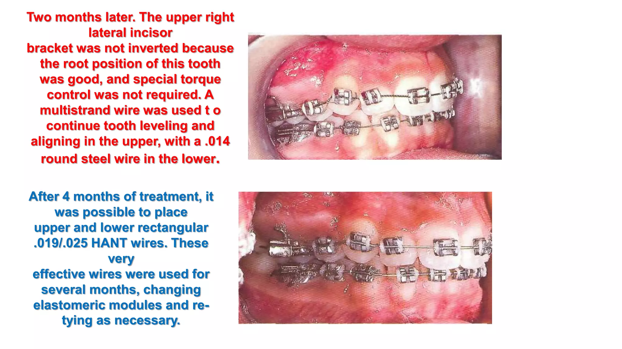 MBT wire sequence during orthodontic alignment and leveling | PPTX