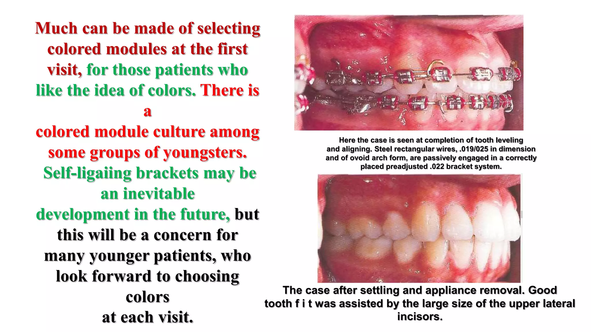MBT wire sequence during orthodontic alignment and leveling | PPTX