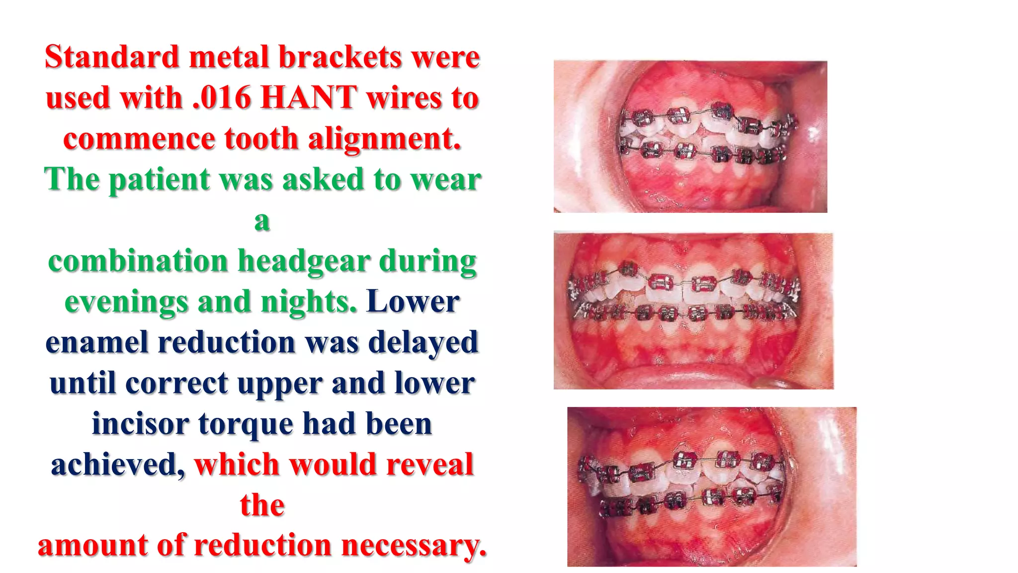 MBT wire sequence during orthodontic alignment and leveling | PPTX