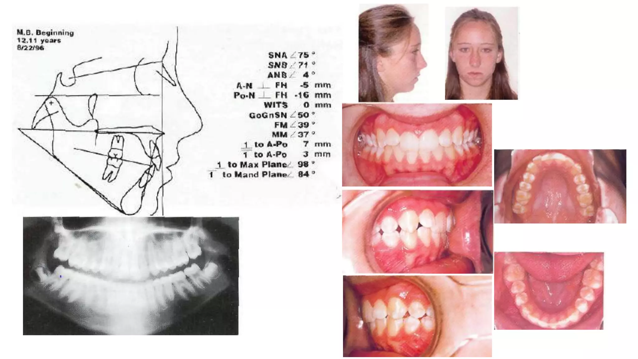 MBT wire sequence during orthodontic alignment and leveling | PPTX