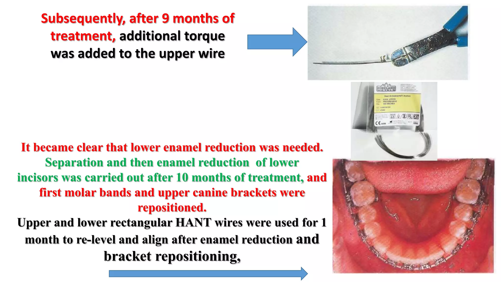 MBT wire sequence during orthodontic alignment and leveling | PPTX