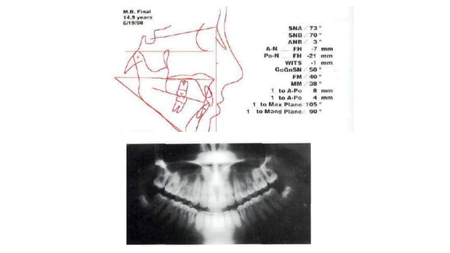 MBT wire sequence during orthodontic alignment and leveling | PPTX ...