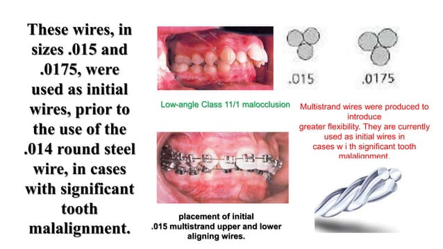 MBT wire sequence during orthodontic alignment and leveling | PPTX ...