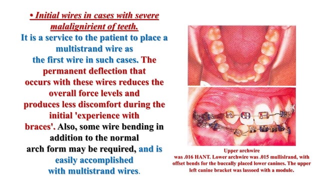 MBT wire sequence during orthodontic alignment and leveling | PPTX ...